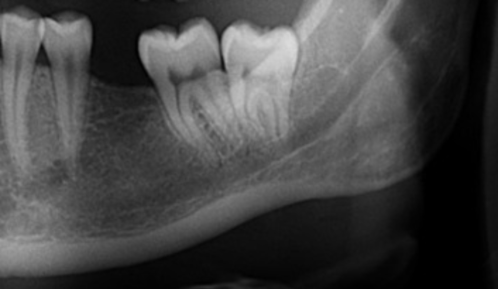 Fluorosis dental: causas, prevención y opciones estéticas